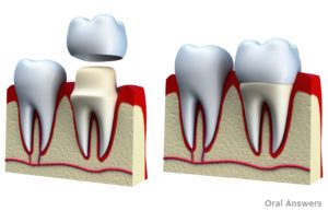 Re-Cement Tooth: What To Do When You Need Help - Best Root Canal ...