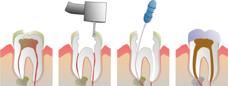 What Happens During Root Canal Surgery? - Best Root Canal Specialist NYC