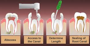 What Happens During Root Canal Surgery? - Best Root Canal Specialist NYC